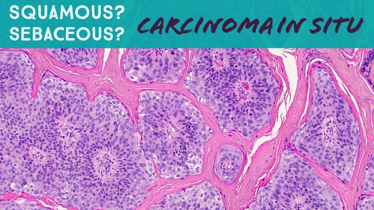 Squamous cell carcinoma in situ with vacuoles vs Sebaceous carcinoma in ...