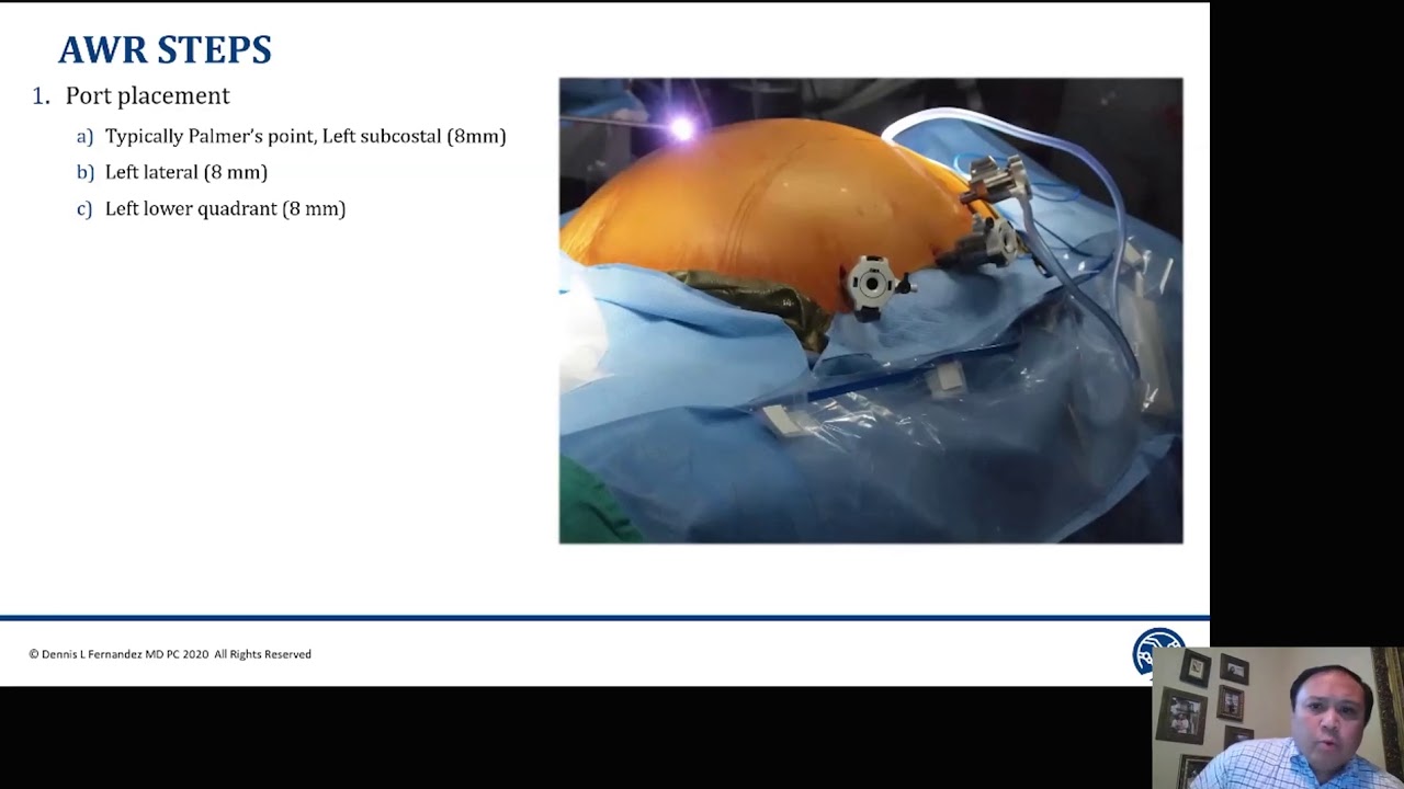 Abdominal Wall Reconstruction – Transversus Abdominus Muscle Release ...