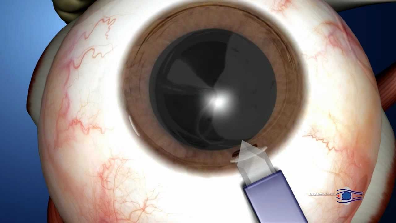 3d Medical Animation Cataract Surgery By Dr Roberto Aguilar