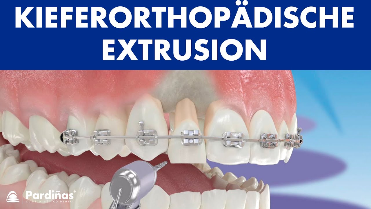 Kieferorthopädische Extrusion © - YouTube