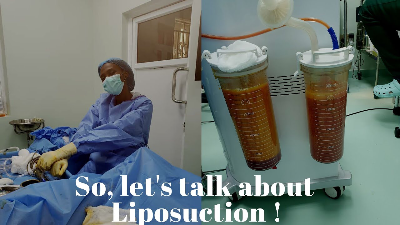 Liposuction and Fat transfer // Types of liposuction // 5 things you ...