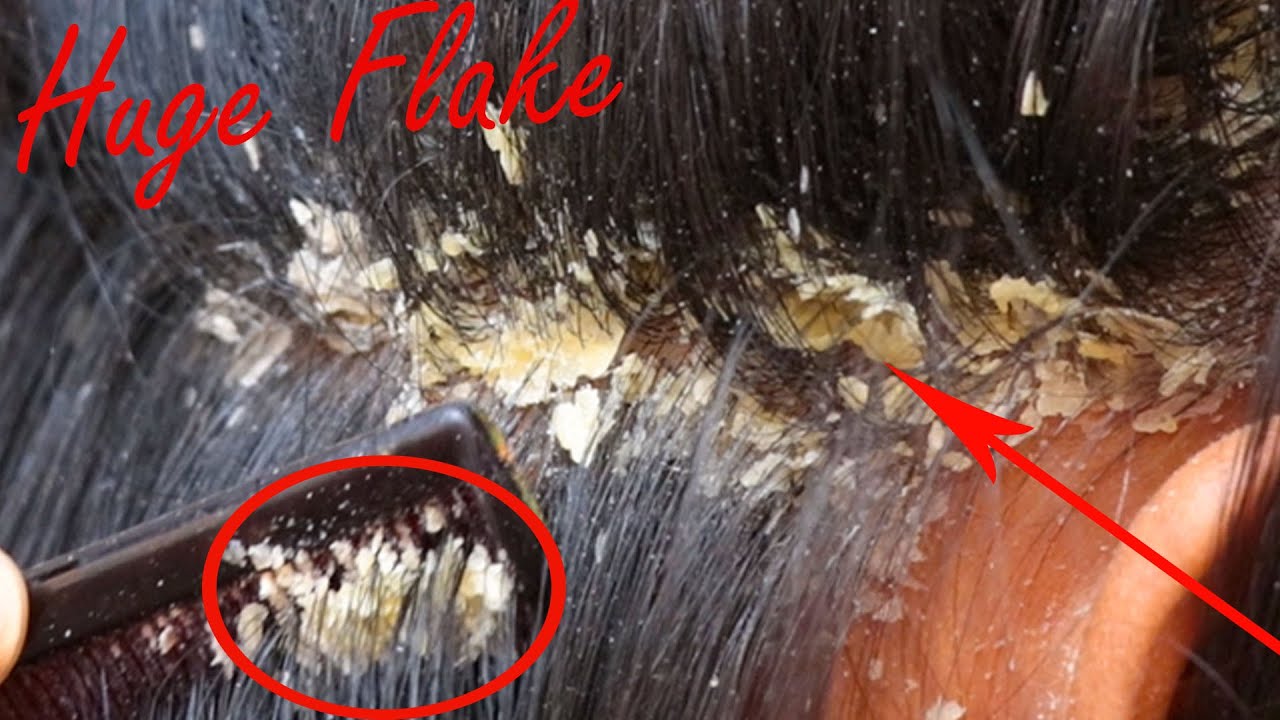 Wow Look So Nice Natural Dandruff In Pity Girl Head!! Big Dandruff ...