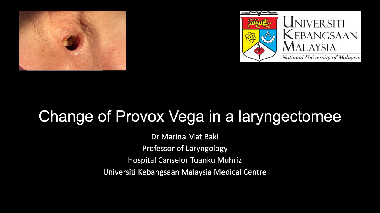 Change of voice prosthesis (Provox Vega) in a laryngectomee - YouTube