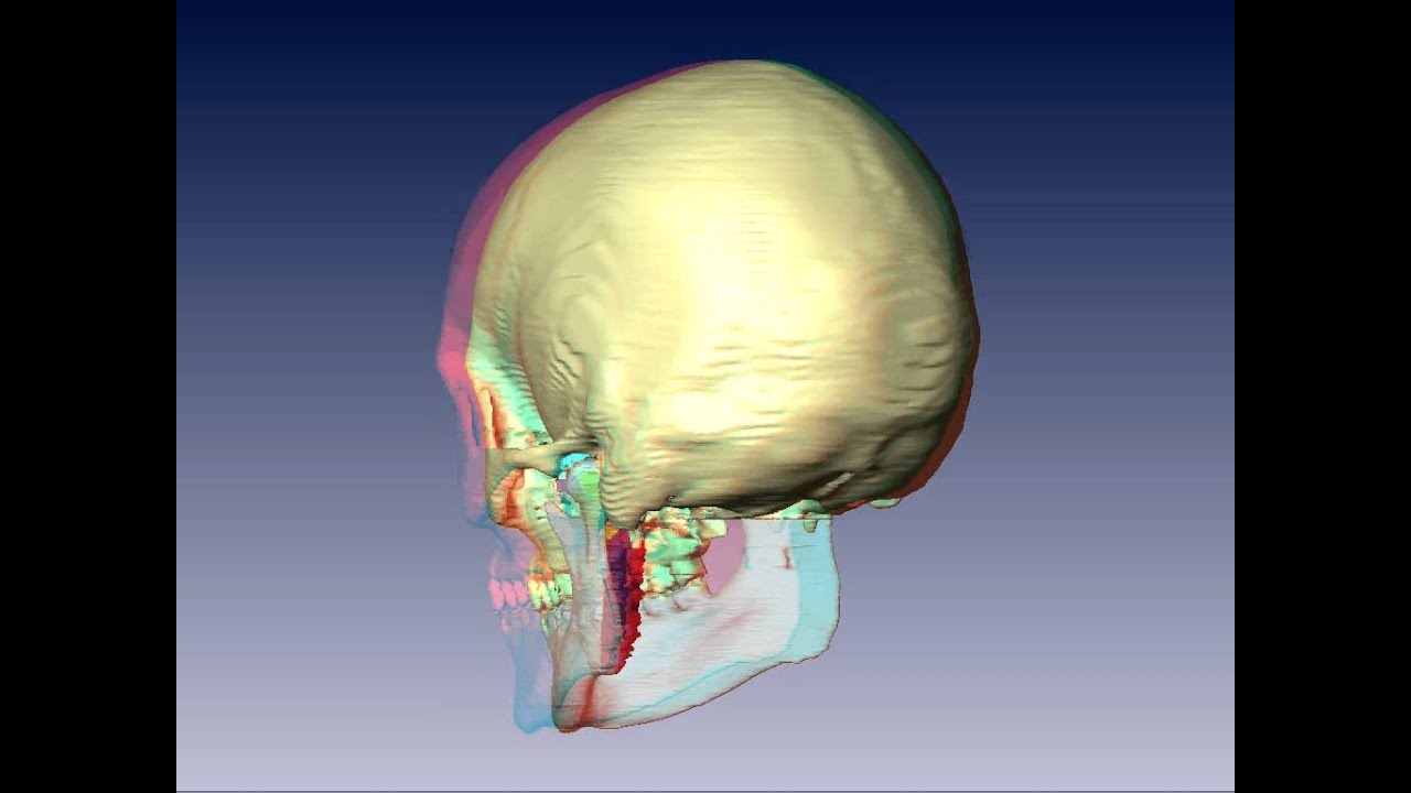 modélisation 3D des muscles masseter et temporaux - YouTube