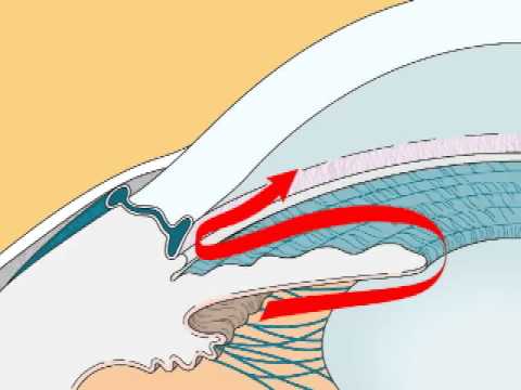 Normal Aqueous Drainage + Open-Angle Glaucoma + Glaucoma Filtering ...