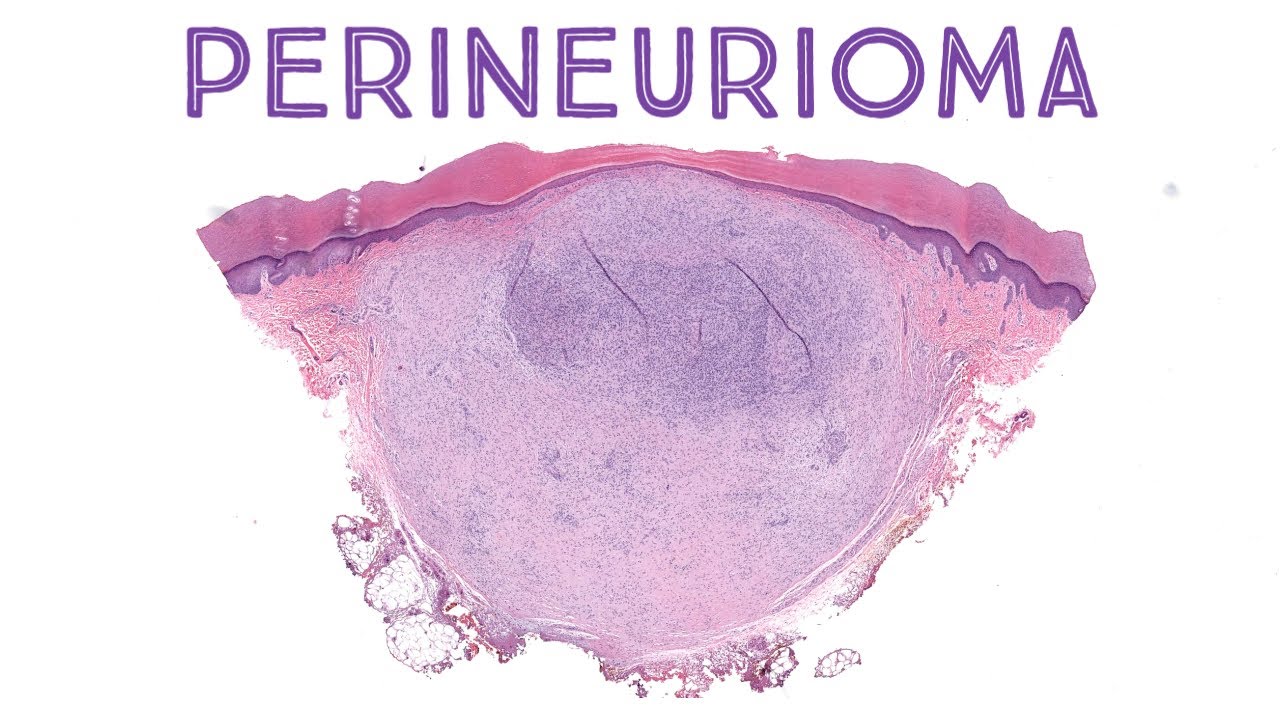 Perineurioma - a benign & beautiful skin tumor! (Stony Brook case 3 ...