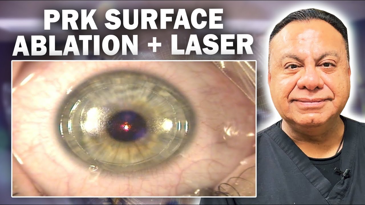 PRK Surface Ablation with Laser Eye Treatment - YouTube