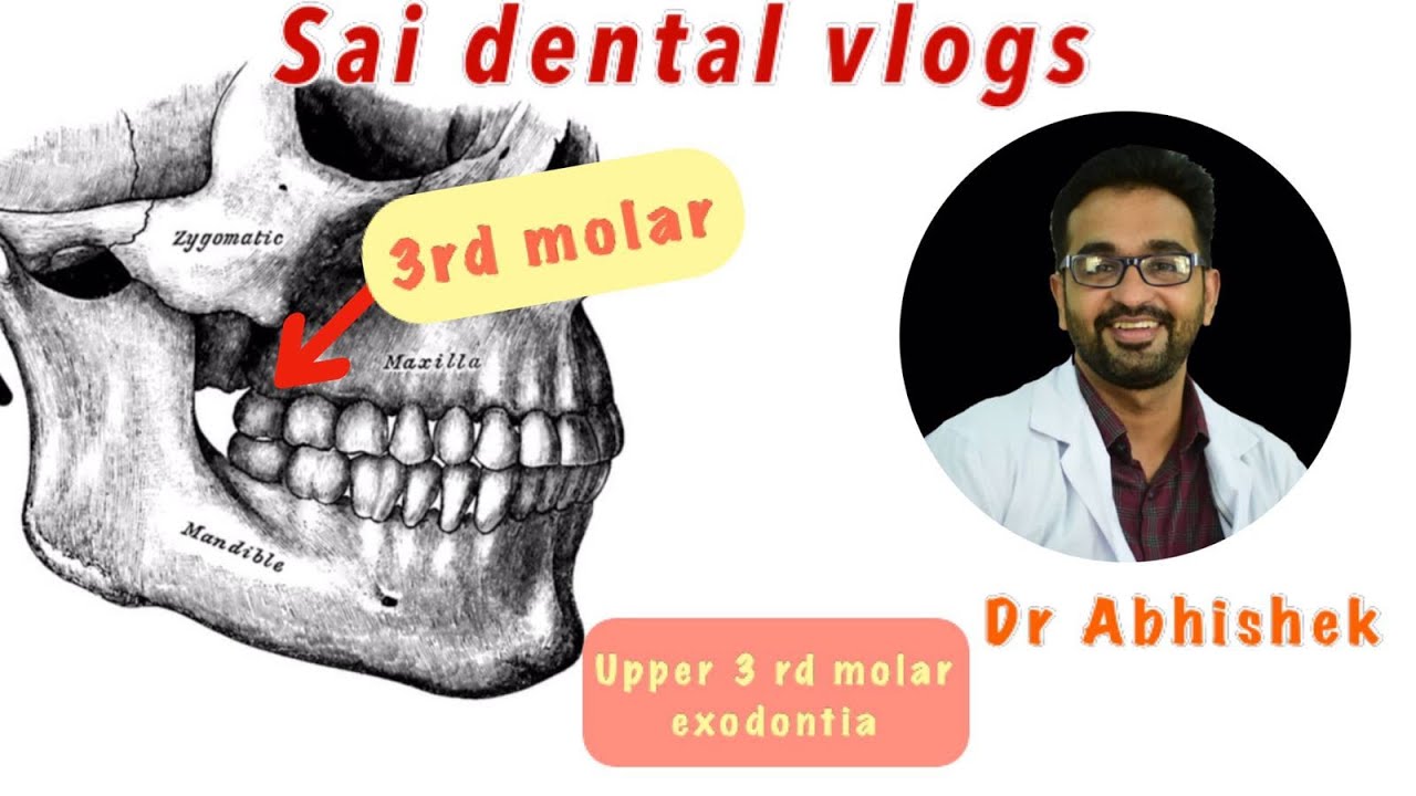 UPPER THIRD MOLAR - EXODONTIA - YouTube