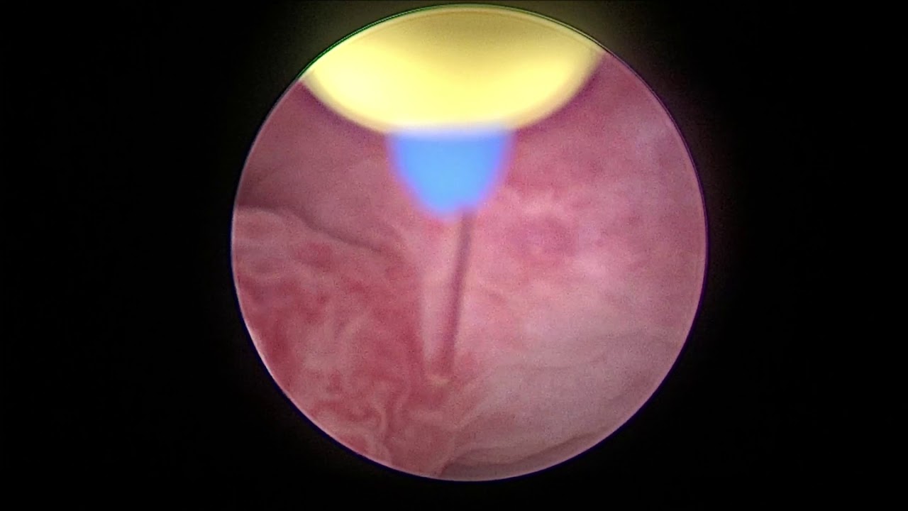 Bladder polyp laser removal - YouTube
