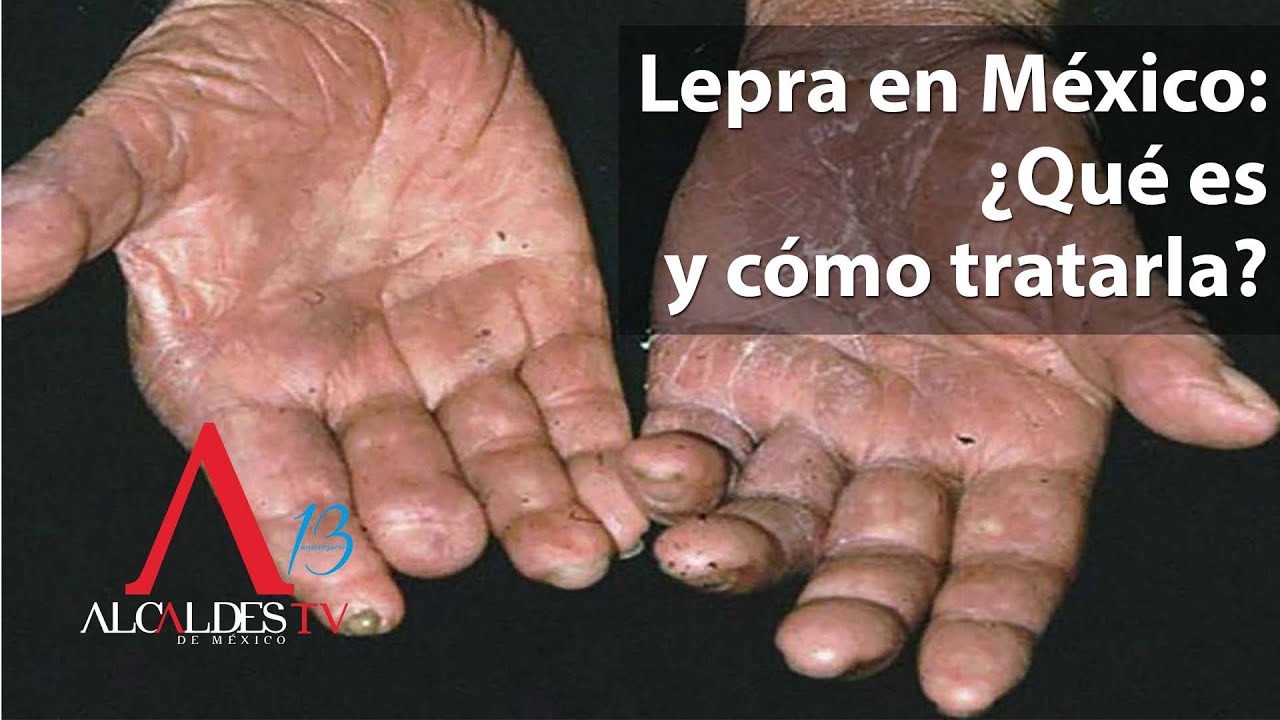 Lepra en México: ¿Qué es y cómo tratarla? - YouTube