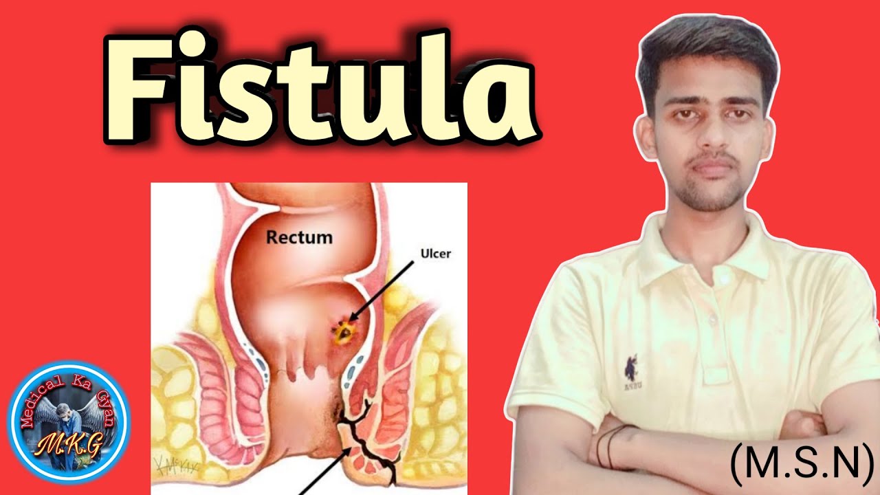 Fistula | fistula kya hai | fistula in MSN | fistula in nursing | B.sc ...