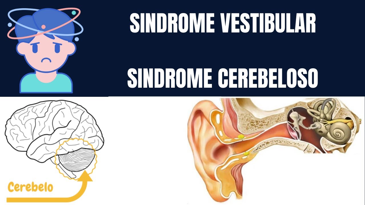 Síndrome vestibular y Síndrome cerebeloso - YouTube