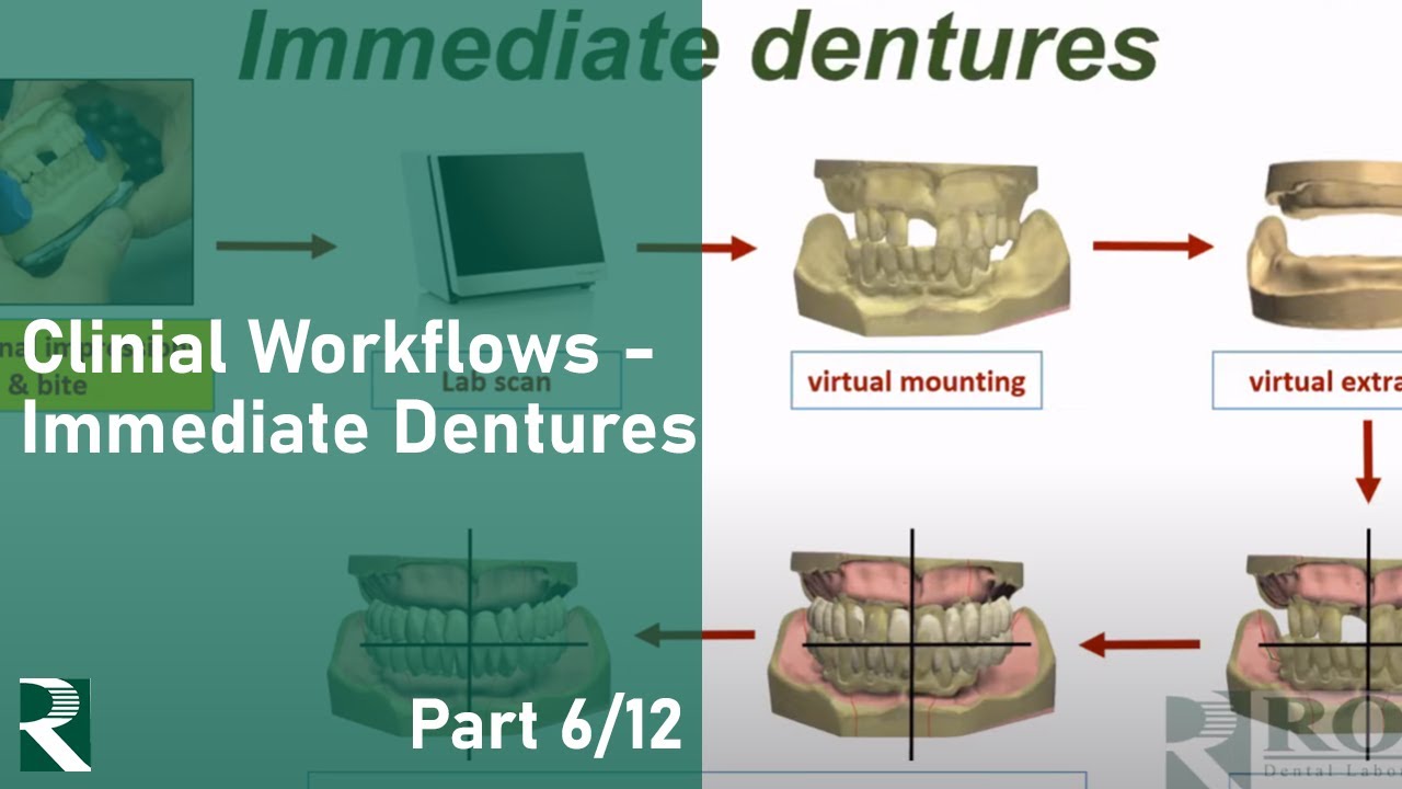 Transition Toward Digital Dentures: Clinical Workflows - Immediate ...