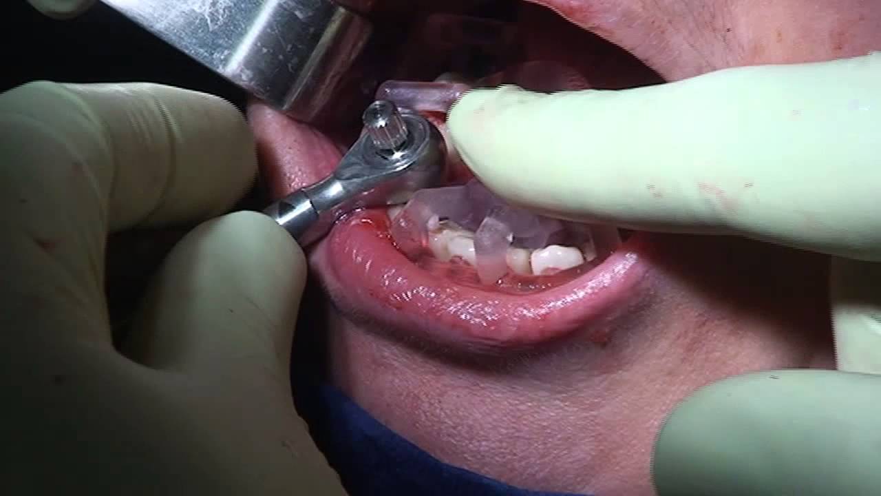 Narrow Diameter Mis Seven Implant Placement And Gbr System Mguide Youtube