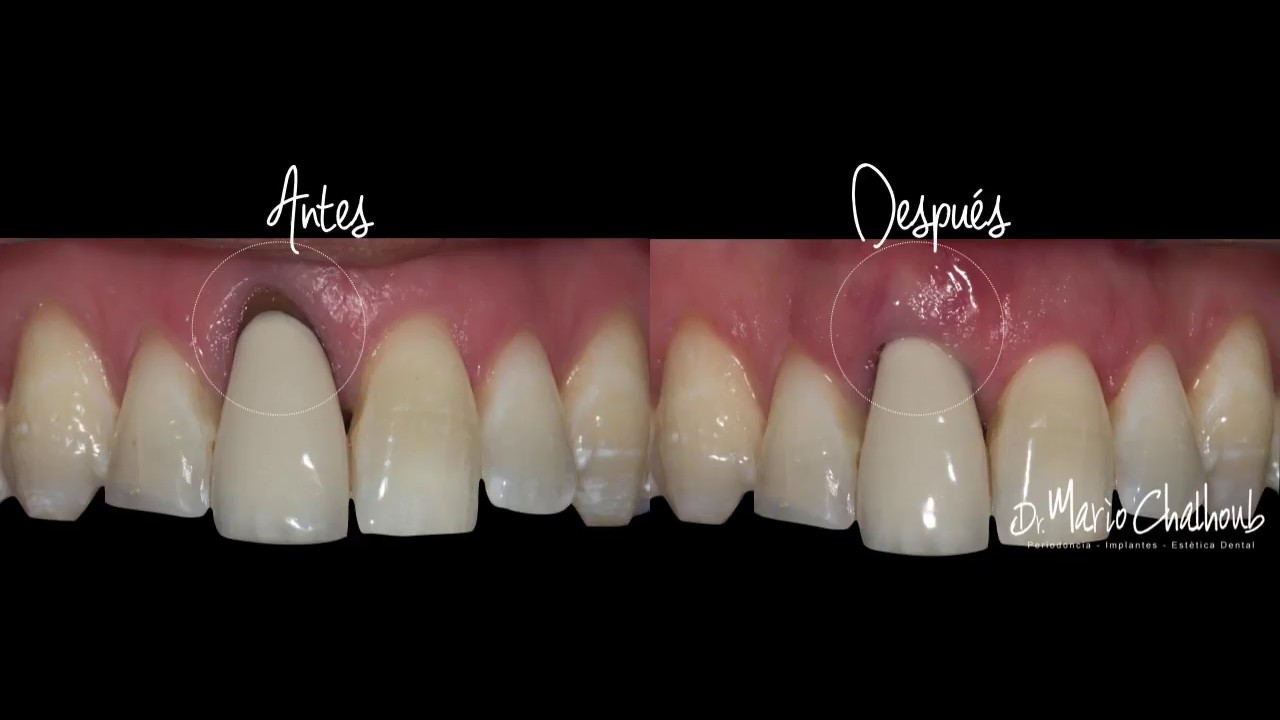 Enfermedad de la encía Recesión Gingival Dr. Mario Chalhoub Periodoncia ...