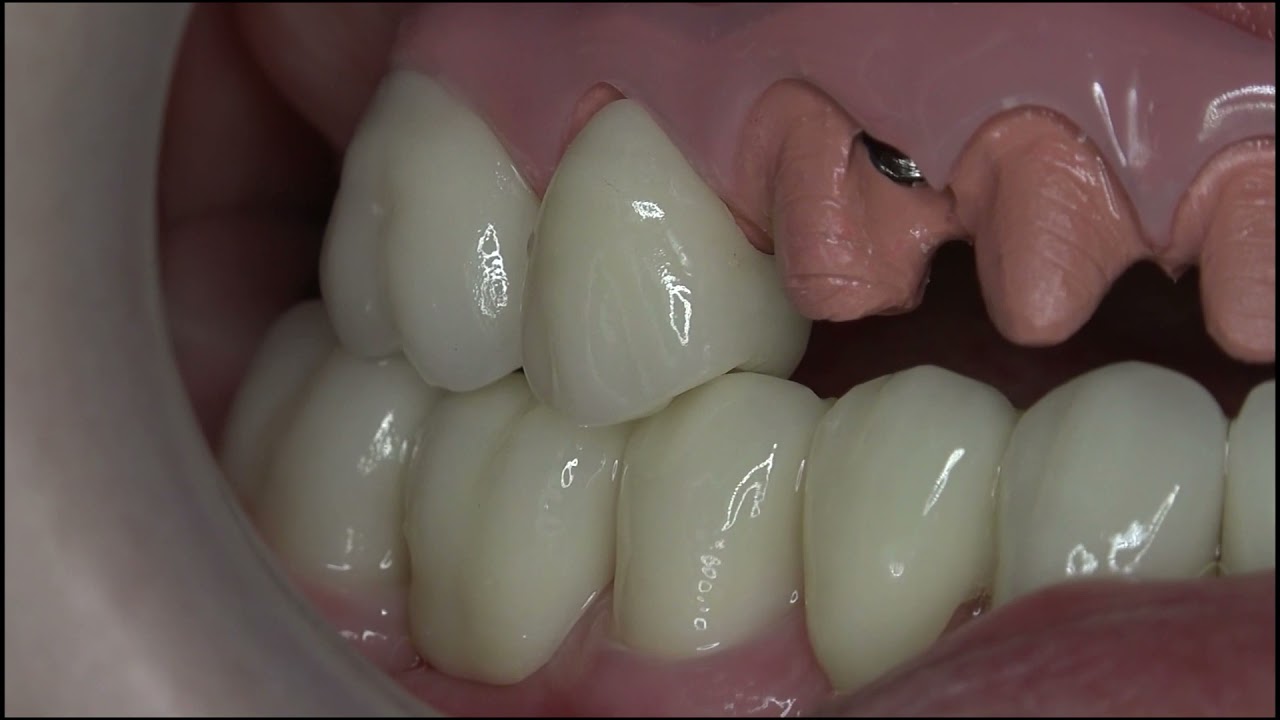 How to avoid occlusal interference - YouTube