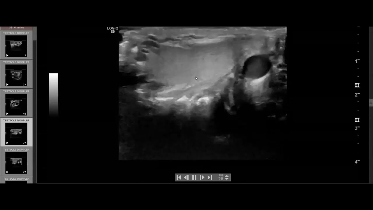 Pitfall of bilateral Varicocele...Small parts ultrasound - YouTube