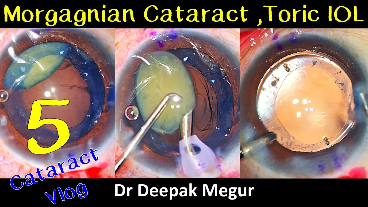 Toric IOL in an Hypermature Morgagnian Cataract: Cataract VLOG 5 - YouTube