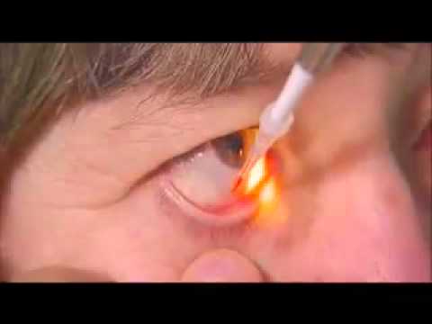 Tear Film Breakup Time - YouTube