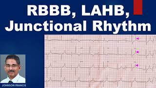Junctional Bradycardia Sinus Bradycardia: Definitions, ECG, Causes And