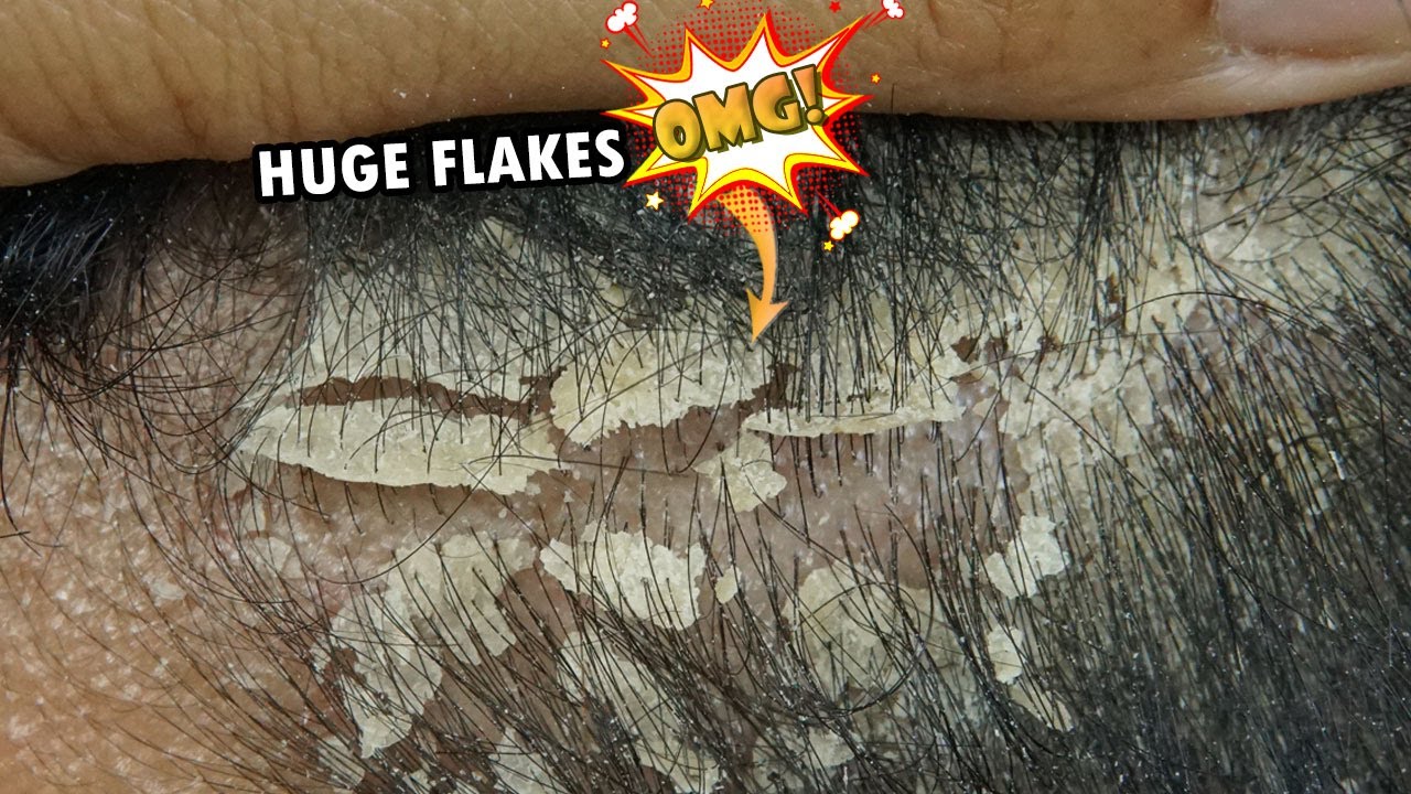 Scratching Huge Dandruff Pile Up Satisfying #527 - YouTube