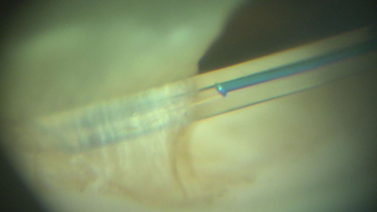 A Paul Glaucoma Implant on gonioscopy around 6 weeks after implantation ...