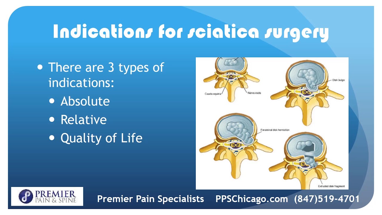 Indications for Sciatica Surgery from a Chicago pain clinic (847) 519 ...