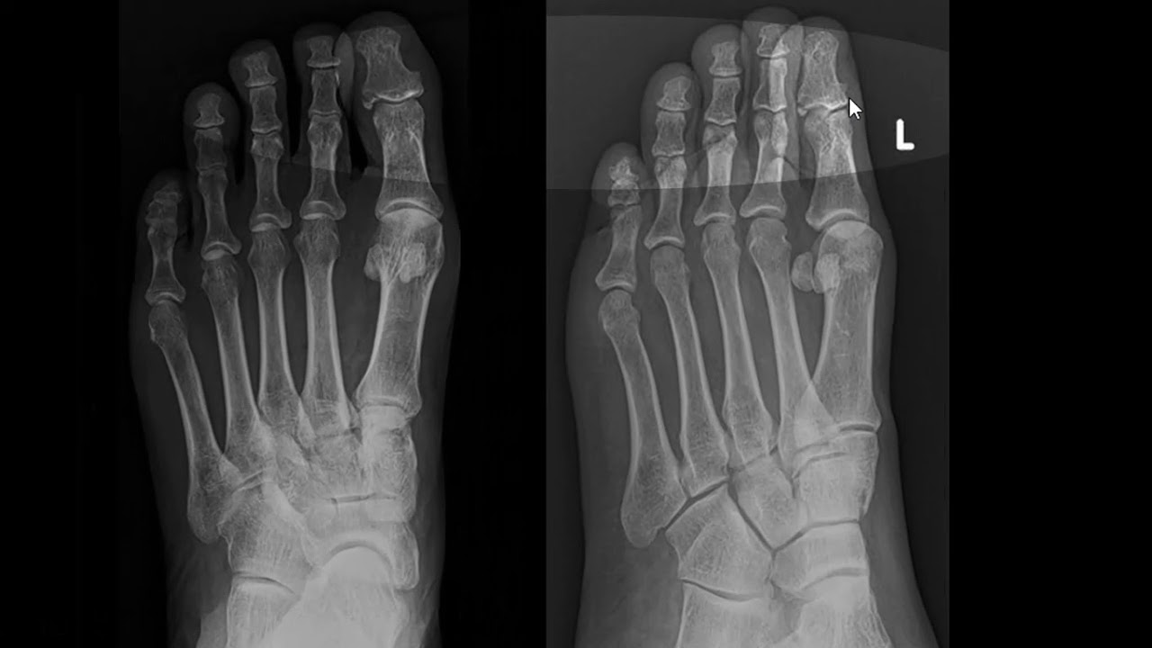 Falange Distal Do Pe