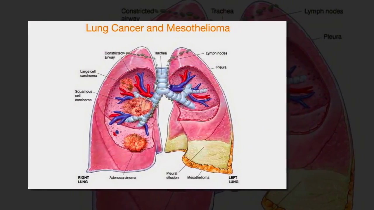 Stage 3 Copd Emphysema