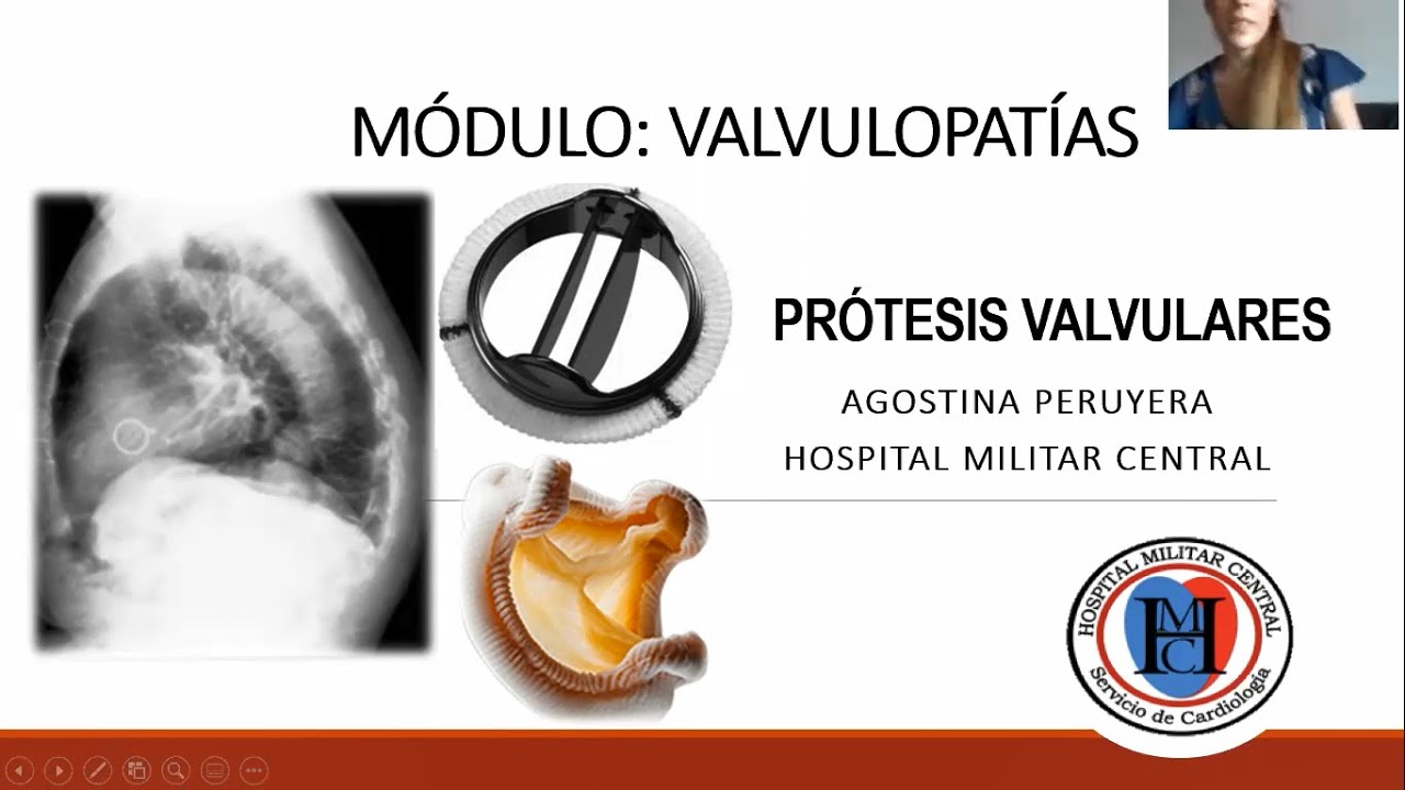 Prótesis valvulares- Módulo de valvulopatías - YouTube