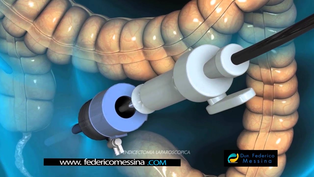 Appendicectomia Laparoscopica Dr. Messina - YouTube