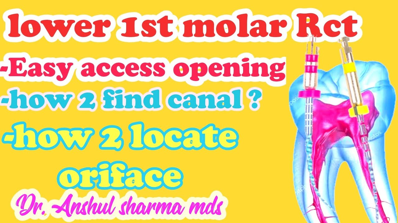 MANDIBULAR FIRST MOLAR|LOWER MOLAR|ACCESS OPENING|MANDIBULAR MOLAR ...