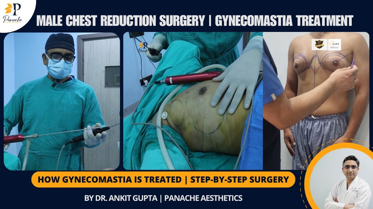 How is Gynecomastia Treated | How to Improve Gynecomastia Results ...