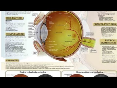 Retinal vein occlusion (CRVO,BRVO, ISCHAEMIC,NON ISCHEMIC CRVO ...