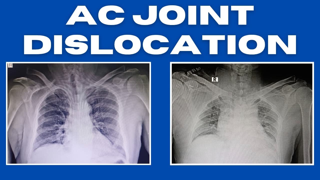 AC JOINT DISLOCATION WITH ARTHREX DOG BUTTON TECHNIQUE IN AN ELDER ...