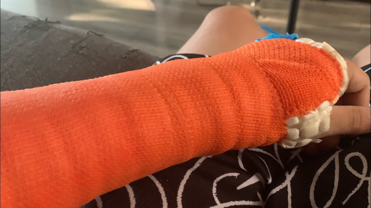Broken arm series, part 5 - YouTube