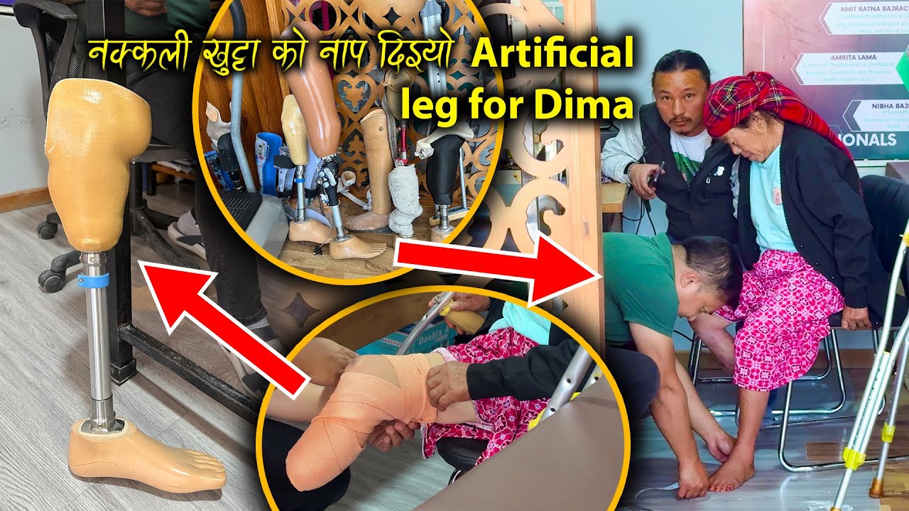 Aunt's foot was measured for a prosthetic leg || Artificial Leg, limb ...