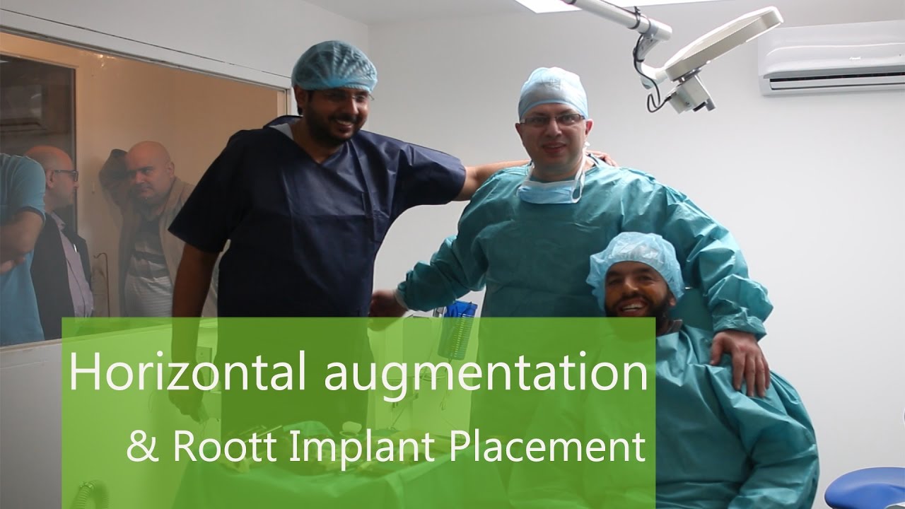 Horizontal augmentation and Roott implant placement - YouTube