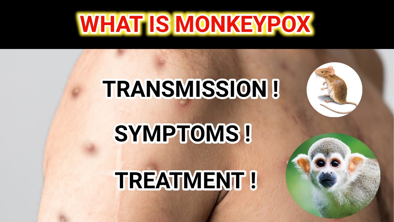 Monkeypox virus | Mpox | Causes, Symptoms, Treatment, and Prevention ...