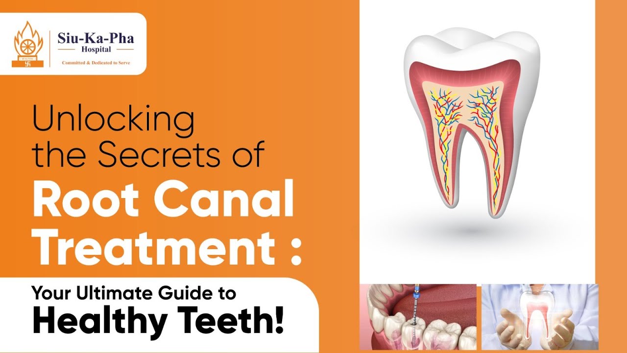 Unlocking the Secrets of Root Canal Treatment (RCT): Your Ultimate ...
