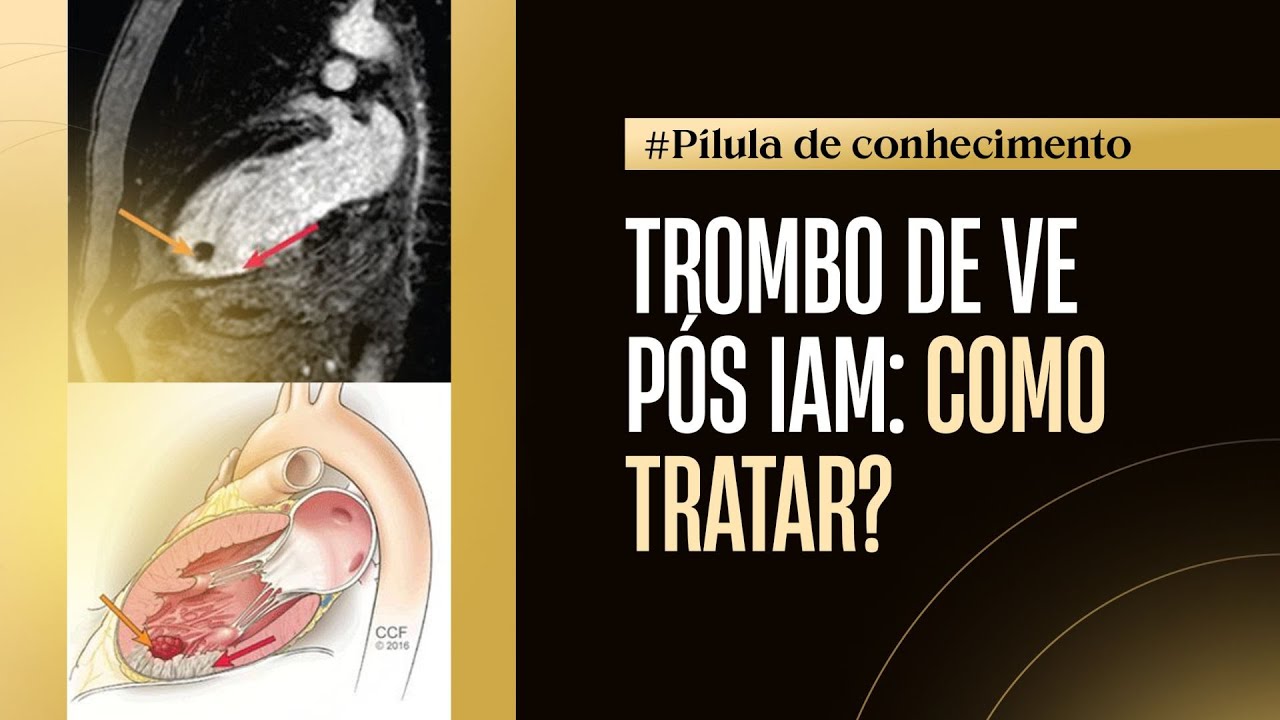 #007 Trombo de VE pós IAM Como Tratar? / Podcast Cardiologia na Prática ...