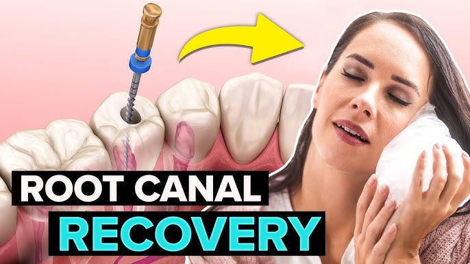 Root Canal Process Step 2