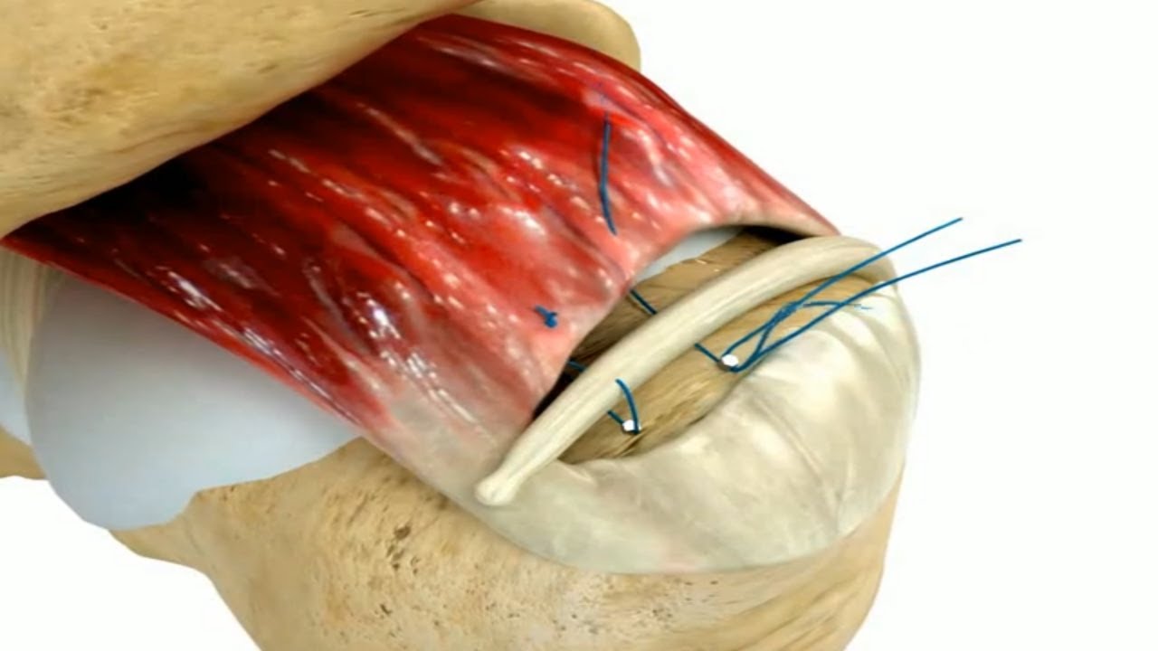Biceps Augmentation in Rotator Cuff Repair: Enhancing Stability 회전근개 ...