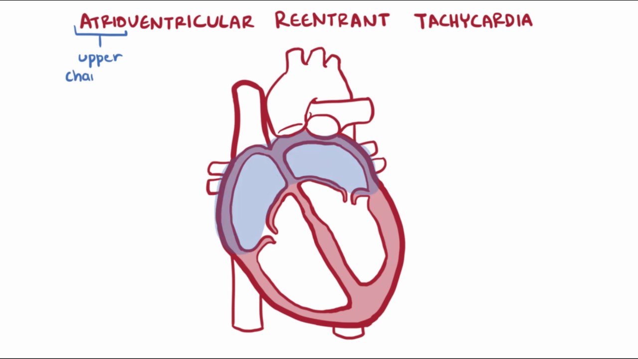 AVRT N AVNRT - YouTube