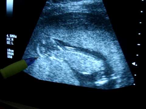 13 Weeks Ultrasound - Here is our little boy! - YouTube