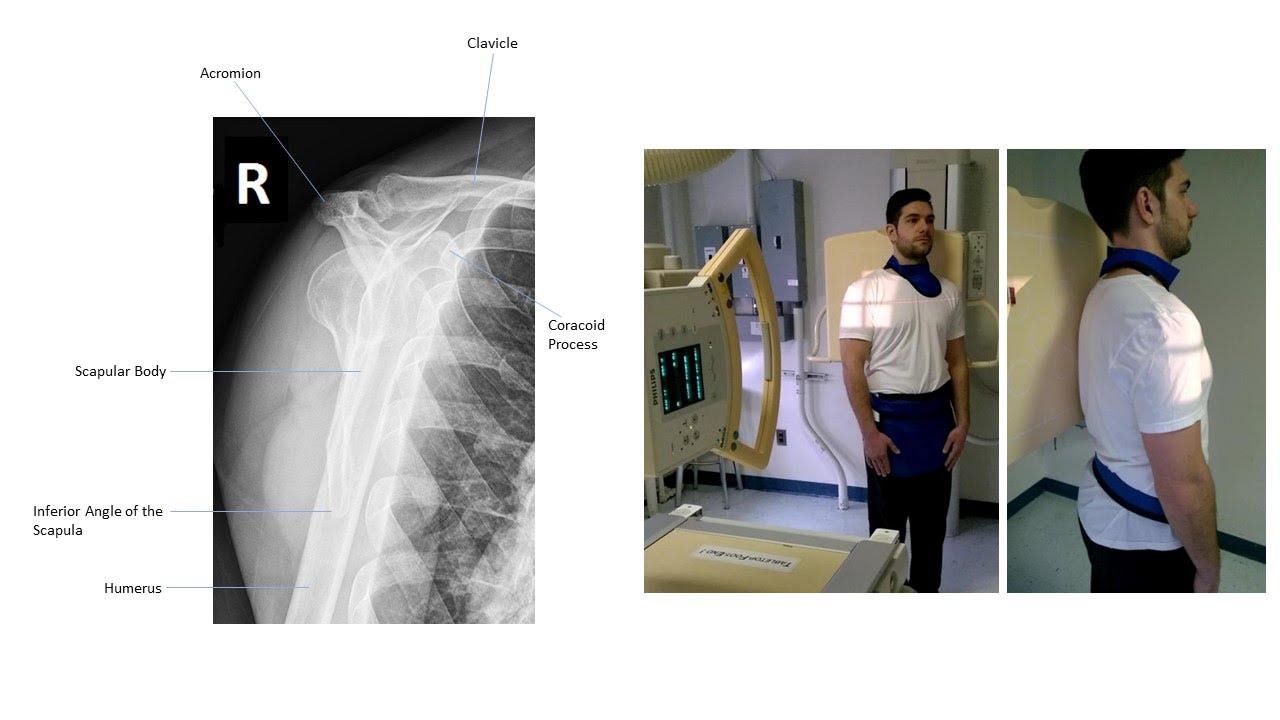 Shoulder X-Ray | AP Y-View - YouTube
