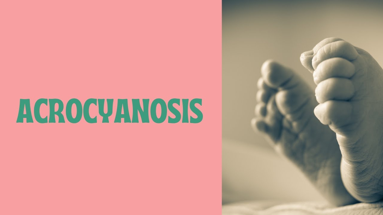 Acrocyanosis - YouTube