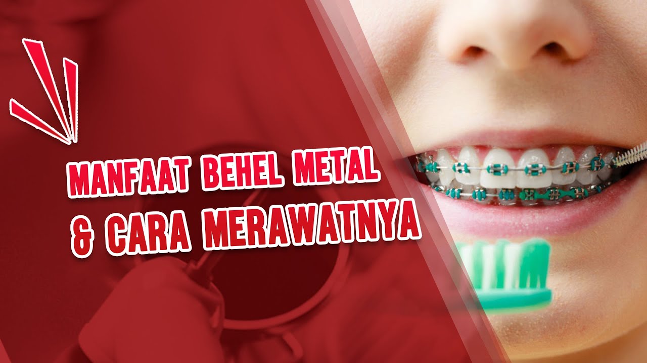 Manfaat Behel Metal & Cara Merawatnya | Dental Universe Indonesia - YouTube