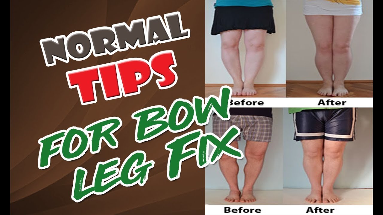Normal tips for bow leg fix - best result for Normal tips for bow leg ...