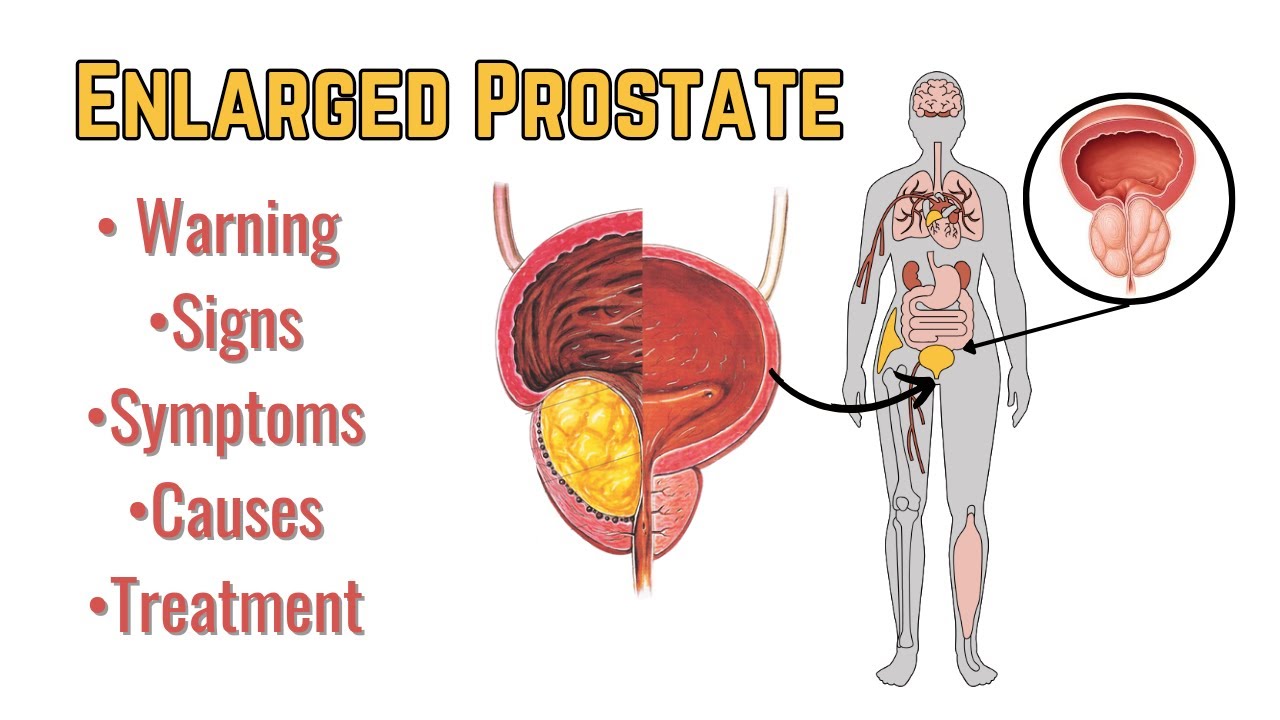 ENLARGED PROSTATE ! MENS Warning Signs & Symptoms - Benign Prostatic ...